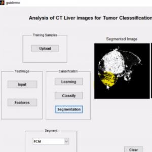 Liver Tumor detection using matlab