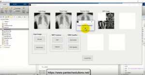 Tuberculosis detection in XRAY images using Matlab -Image processing ...