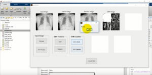 Tuberculosis detection in XRAY images using Matlab -Image processing projects