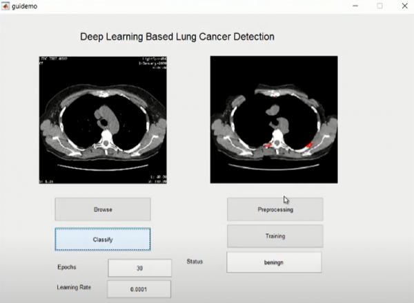 Lung Cancer Detection using Deep Learning